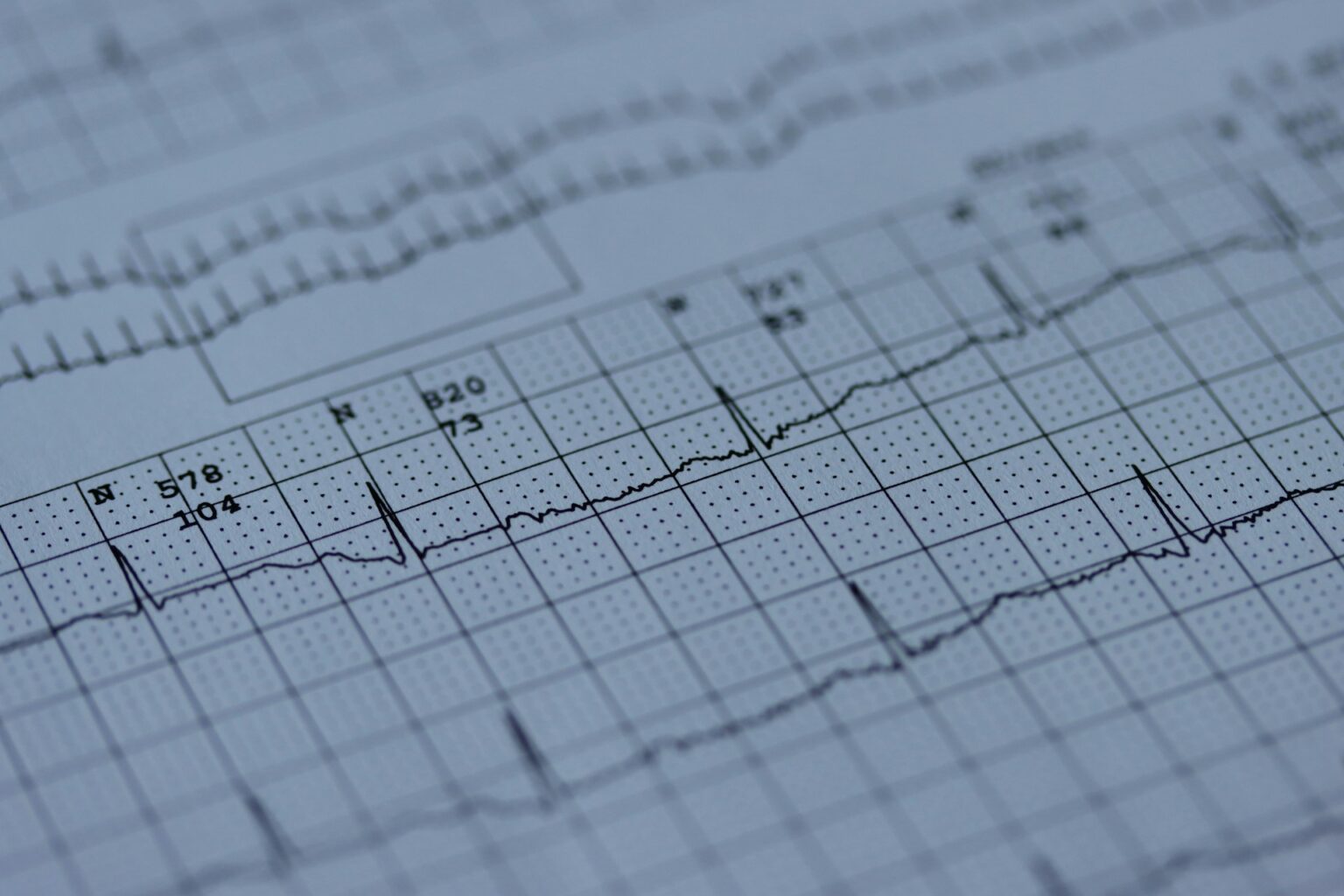 What is ECG and What it Means When There are Abnormalities in the Test ...
